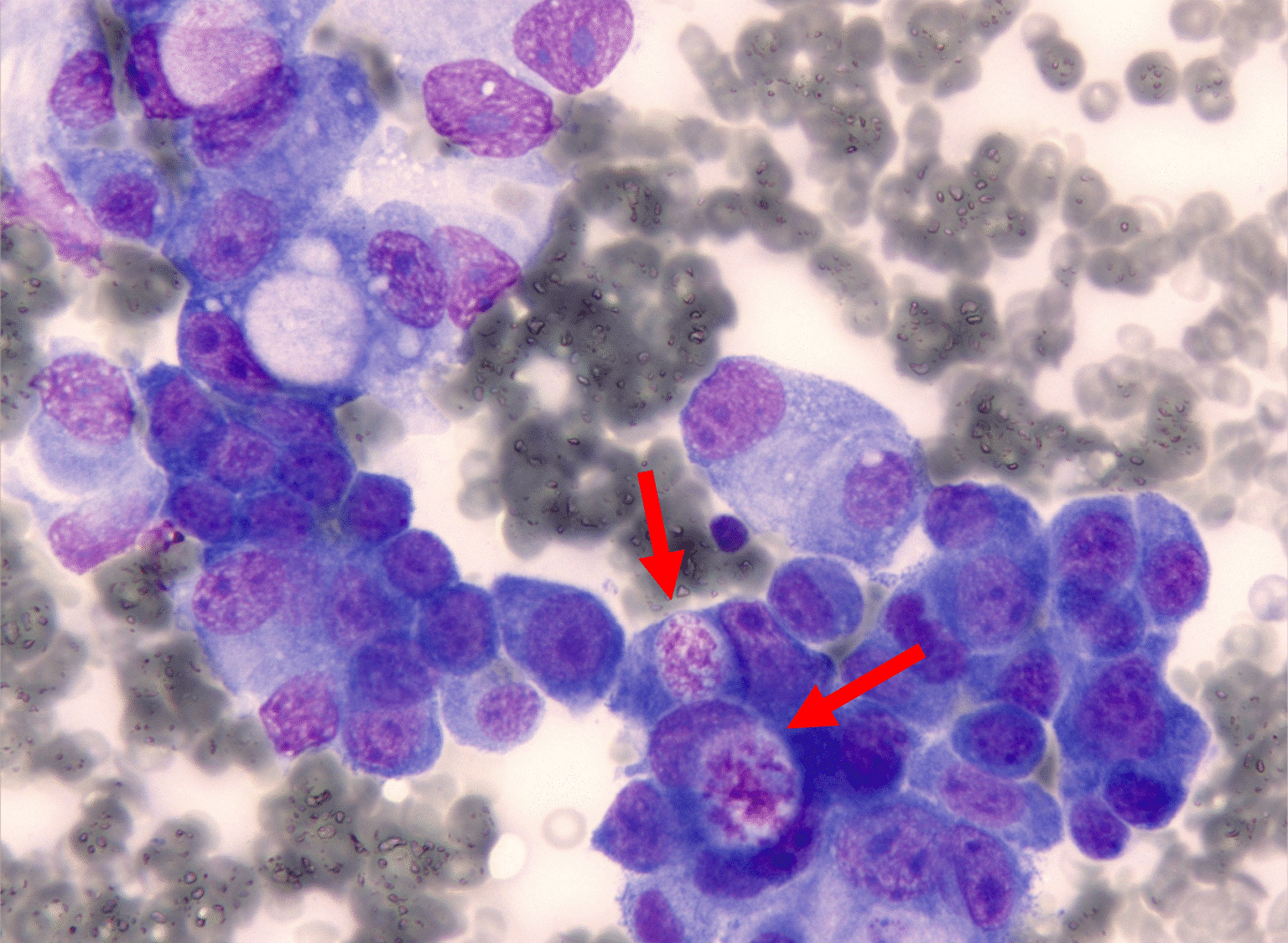 Geste technique + Vidéo du mois : Oncologie | FREGIS, hôpital ...
